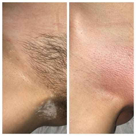List Pictures Brazilian Wax Before And After Pictures Tumblr Superb