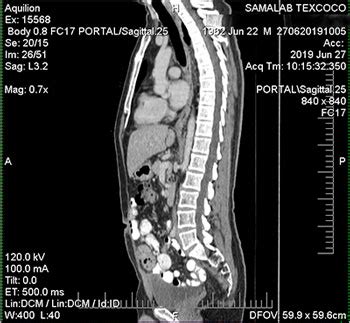 Tomografia Del Abdomen