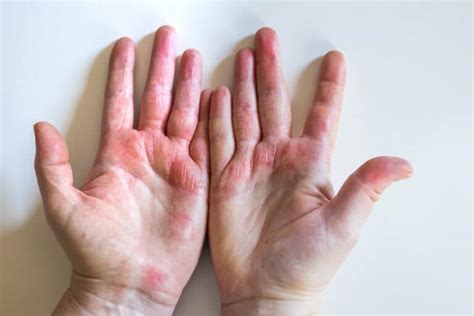 Dyshidrose symptômes et traitements de l eczéma des pieds et mains