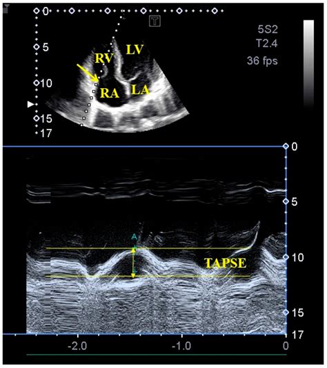 Life Free Full Text The Relationship Between Tricuspid Annular