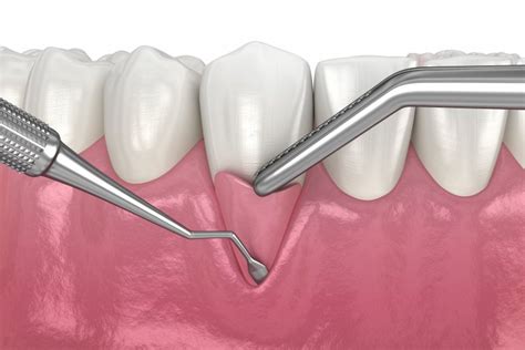 Gum Grafting In Huntington Beach Gum Disease Dr Justin Braga
