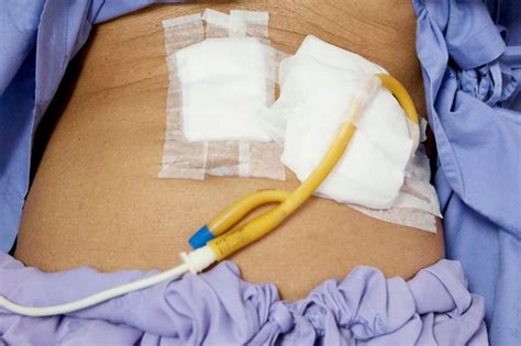 Gastrostomía qué es alimentación y cuidados Tua Saúde