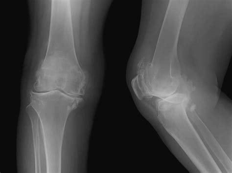 Entdeckt Heilprozesse Bei Arthrose Im Knie