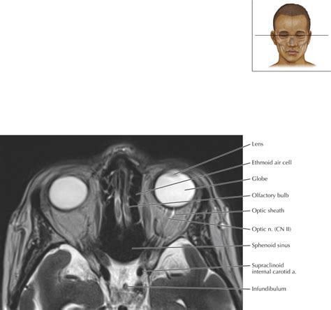 Brainstem And Cranial Nerves Radiology Key