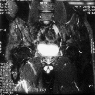 Follow Up Magnetic Resonance Imaging 5 Months After Symptom Onset Shows