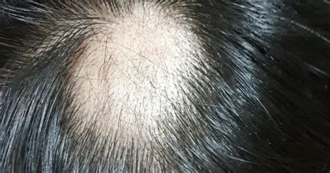 Best 5 Ways How To Stop Alopecia Areata From Spreading
