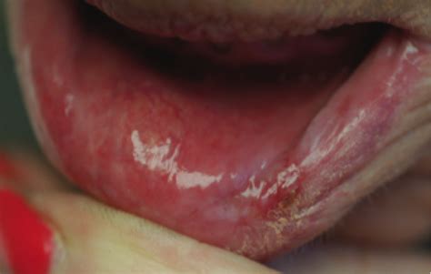 Red Spots On My Inner Lips Lipstutorial Org