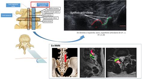 Ecograf A De La Columna Vertebral Lumbar Dolopedia