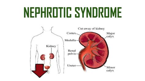 Nephrotic Syndrom Causes Symptoms Treatment Iqbal Health Centre