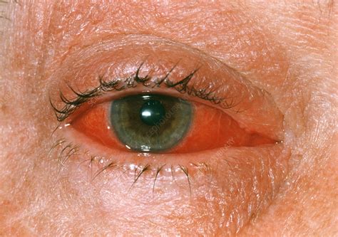 Viral Conjunctivitis Stock Image M Science Photo Library