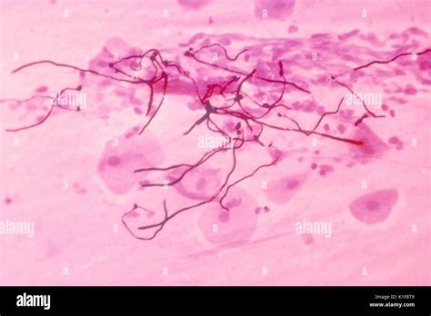 This Gram Stained Micrograph From A Patient With Pulmonary Candidiasis