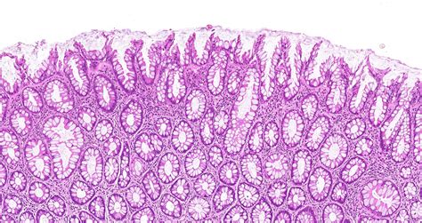 Sessile Polyp Histology