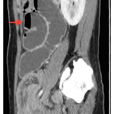 tomodensitométrie TDM abdominale en coupes axiales après injection de