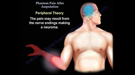 Phantom Pain Amputation Everything You Need To Know Dr Nabil