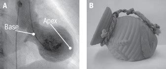 Takotsubo Cardiomyopathy Broken Heart Syndrome Harvard Health