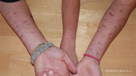 Crece La Moda Del Cutting Entre Adolescentes
