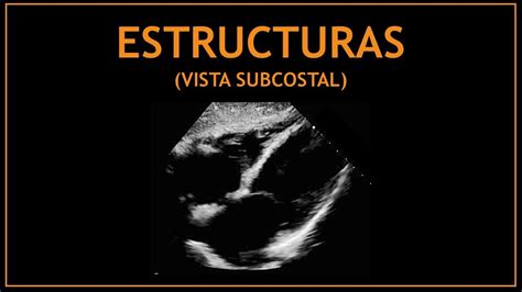 ESTRUCTURAS Cardiacas Vista Subcostal Ecocardiografia YouTube