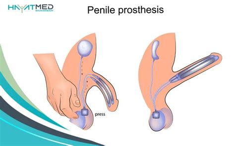 Penile Implant Penuma Implant Cost And Guide In 2024