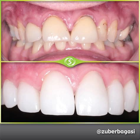 Cosmetic Makeover Case 22 Dr Zuber Bagasi Synergy Dental Clinic