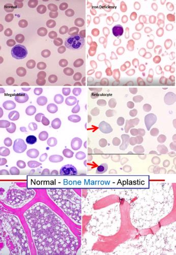 Week Hrm Disorders Of Rbc Wbc Haemostasis Flashcards Quizlet