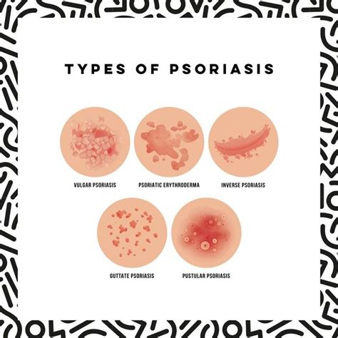 Types Of Psoriasis In 2021 Psoriasis Pustular Psoriasis Types Of Psoriasis