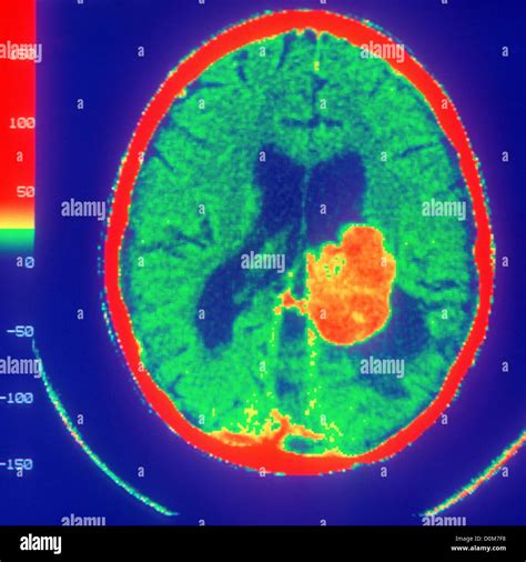 Tomograf A Axial Computarizada Del Cerebro Muestra Tumor Fotograf A De
