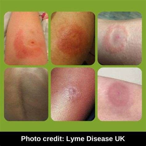 EXPLAINED Lyme Disease Why Its On The Rise And How To Stay Safe