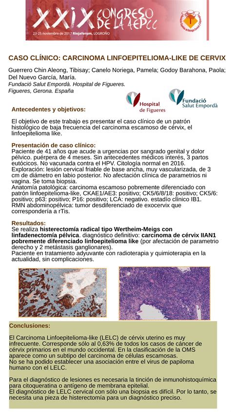 PDF CASO CLÍNICO CARCINOMA LINFOEPITELIOMA LIKE DE Presentación