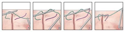 Hysterectomy Cuff Closure Diagram