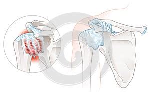 Frozen Shoulder Adhesive Capsulitis Illustration Labeled