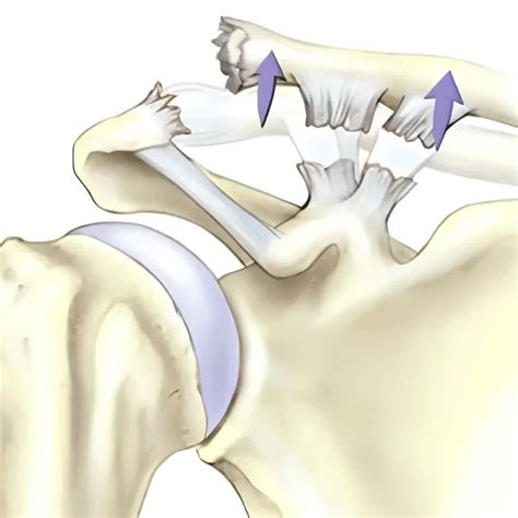 Lesões da articulação acrómio clavicular Clínica do Ombro