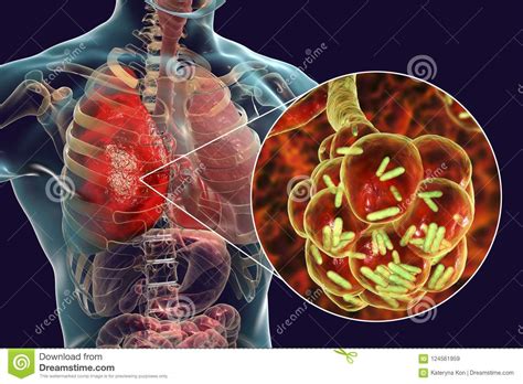 Pneumonia Bacteriana Sintomas Transmiss O E Tratamento