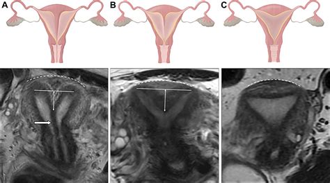 Müllerian Duct Anomalies Role in Fertility and Pregnancy RadioGraphics