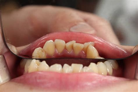 La caries dental Síntomas causas prevención y tratamientos