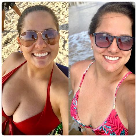 Mamoplastia Redutora Antes E Depois