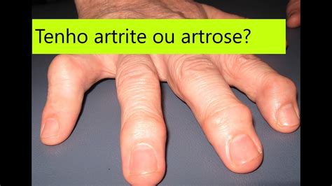 Como Tirar Espinhos Da Mão