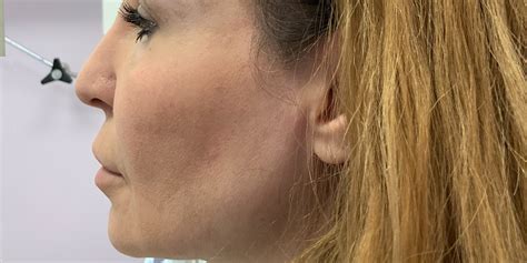 Cheek Fillers Case Study No 1347 Albany Cosmetic And Laser Centre In