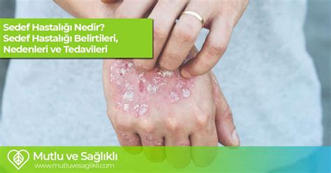 Sedef Hastalığı Nedir Sedef Hastalığı Belirtileri Nedenleri ve Tedavileri