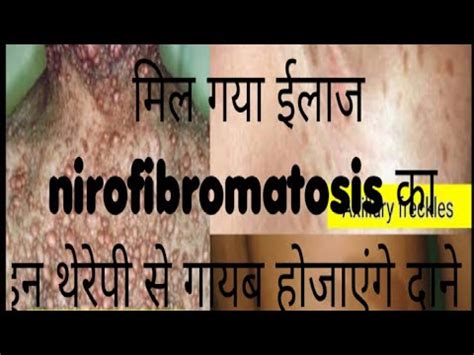 Neurofibromatosis Causes Sign And Symptoms Diagnosis And Treatment
