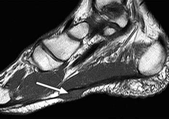 Plantar Fibromatosis Ledderhose Disease Pathology Orthobullets