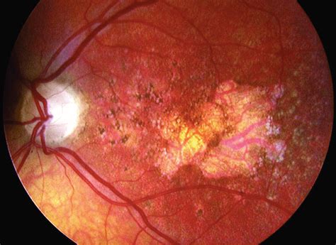 Degeneração Macular relacionada à idade DMRI Retina SP