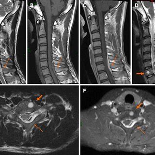 Postoperative Magnetic Resonance Imaging At 6 Mo Follow Up A C