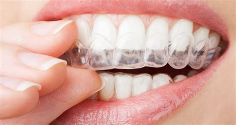 Tipos De Retenedores Dentales Tras Una Ortodoncia