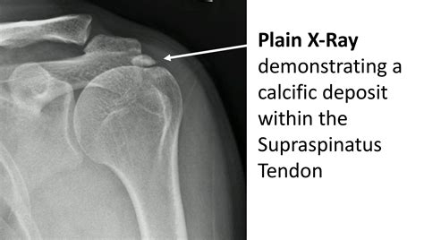 Calcific Tendonitis Cambridge Shoulder
