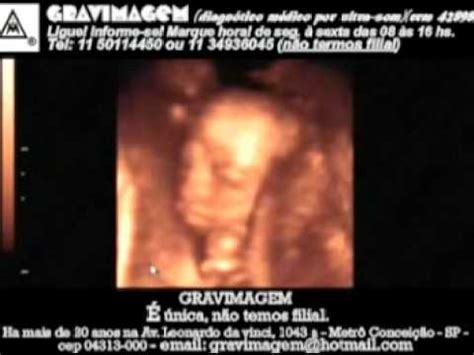 Gravimagem 12639 ultra som morfológico 3D 4D em gravidez 21 semanas