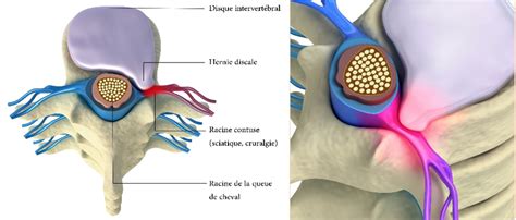 La Hernie Discale Lombaire Chirurgie Du Dos Dr Florent Pennes