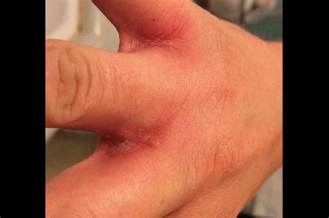 Image Of The Week Erythematous Papules In The Web Spaces Between The