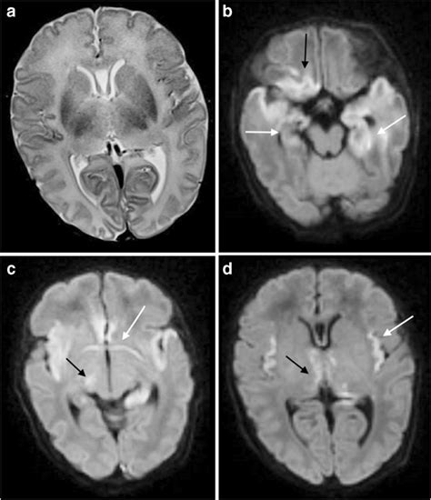 Herpes Simplex Virus Type Encephalitis In A Day Old Girl The Mri