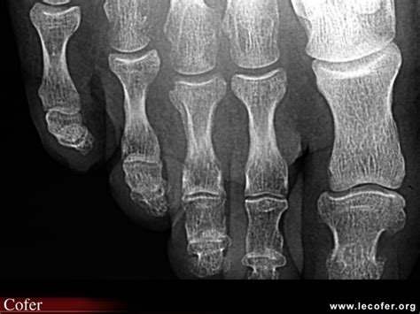 Rhumatisme psoriasique apposition périostée sur P1 Diapothèque du COFER