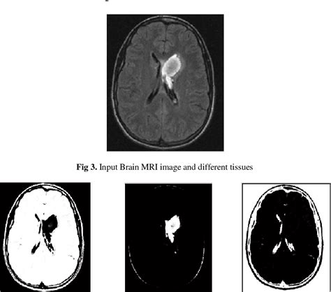 figure 3 from tumor identification in brain mri images using fuzzy c means algorithm semantic